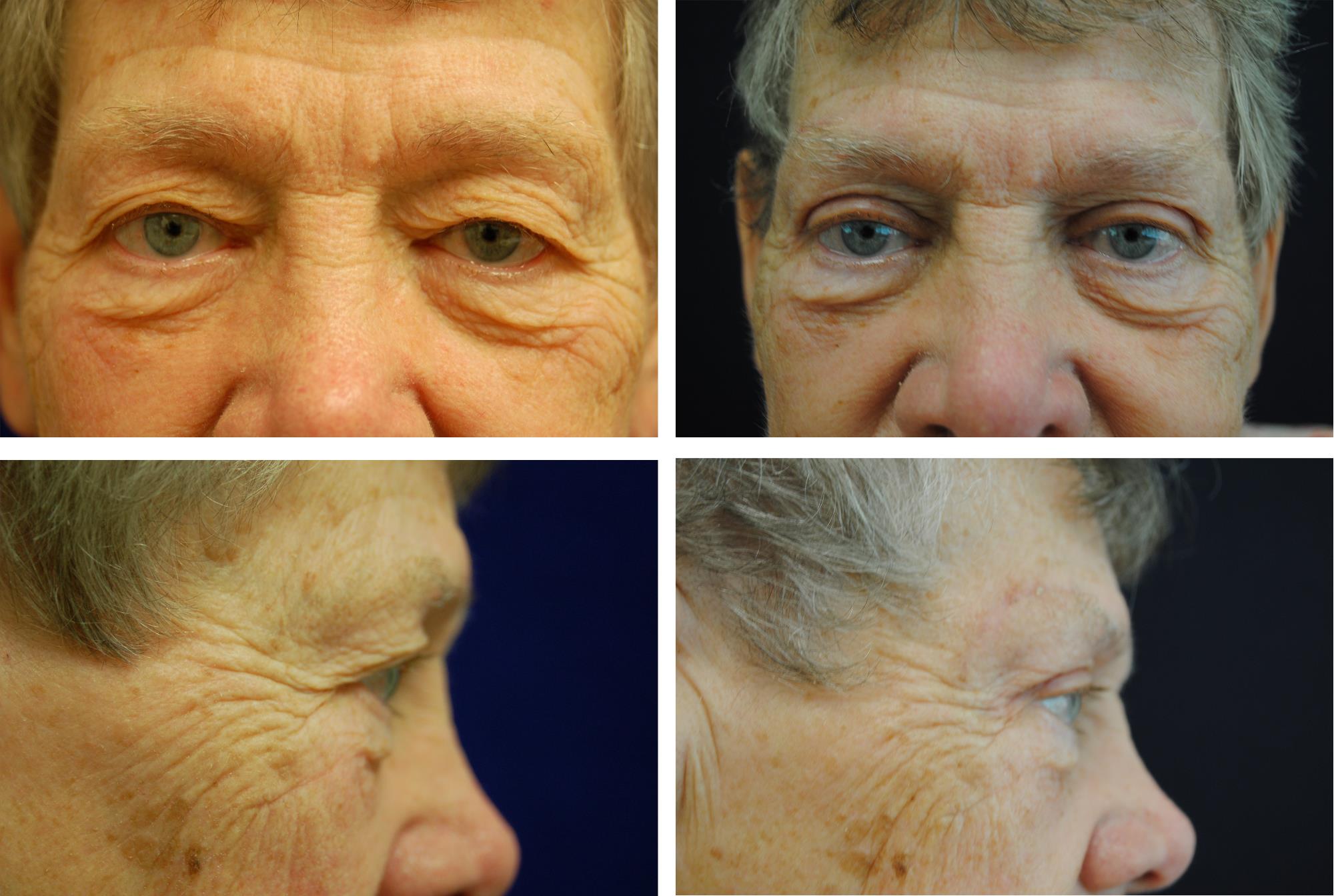 Blepharoplasty Case 7196 - The Plastic Surgery Group