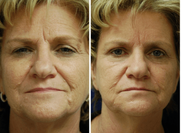 Facial Resurfacing Archives - The Plastic Surgery Group